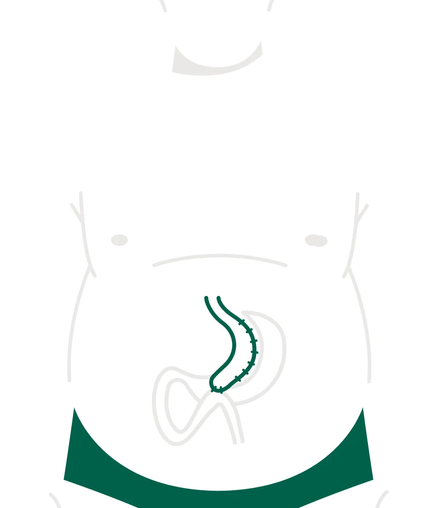 Omega Loop Turkey Treatment - Dr. Feridun Suat Gokce